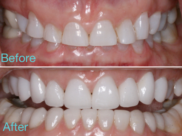 Porcelain Dental Veneers - Cosmetic Dentistry - 212 Smiling