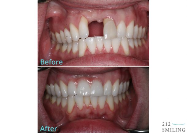 Ceramic Dental Bridge Before and After - 212 Smiling